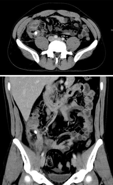 Acute appendicitis with a neuroendocrine tumor G1 (carcinoid): pitfalls ...