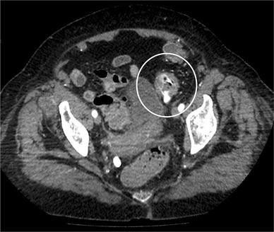Foreign bodies in sigmoid colon diverticulosis | SpringerLink