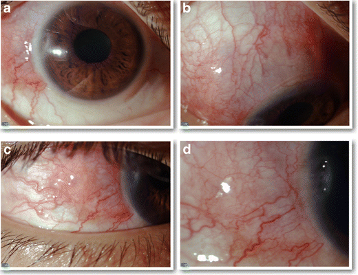 Bilateral scleritis and sclerokeratitis associated with IgA nephropathy ...