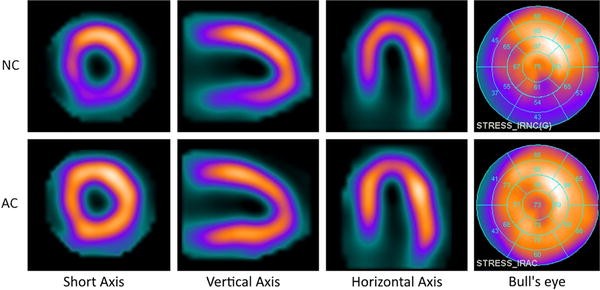 Value of attenuation correction in stress-only myocardial perfusion ...