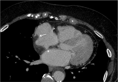 Cardiac Masses on Cardiac CT: A Review | SpringerLink