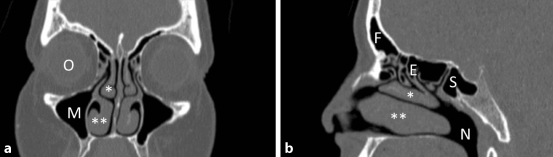 Rinosinusitis en neuspoliepen | SpringerLink