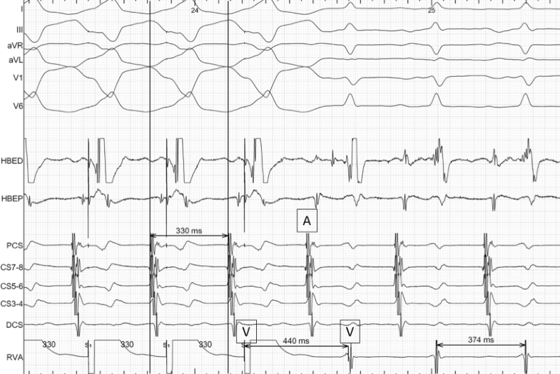 Regular, narrow QRS, long RP tachycardia – what is the mechanism ...