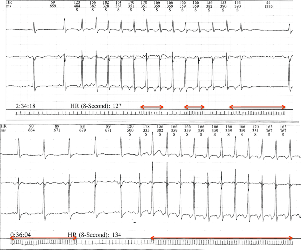 Regular, narrow QRS, long RP tachycardia – what is the mechanism ...