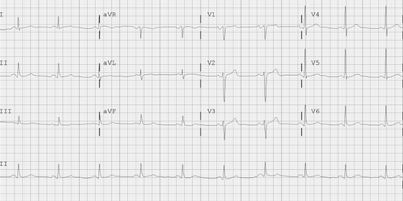 Adenosine administration in supraventricular tachycardia | SpringerLink