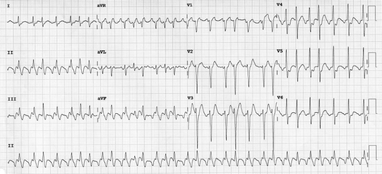 Adenosine administration in supraventricular tachycardia | SpringerLink
