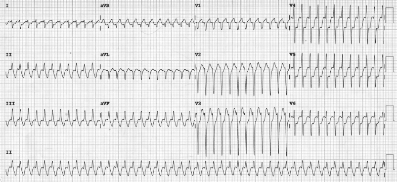 Adenosine administration in supraventricular tachycardia | SpringerLink