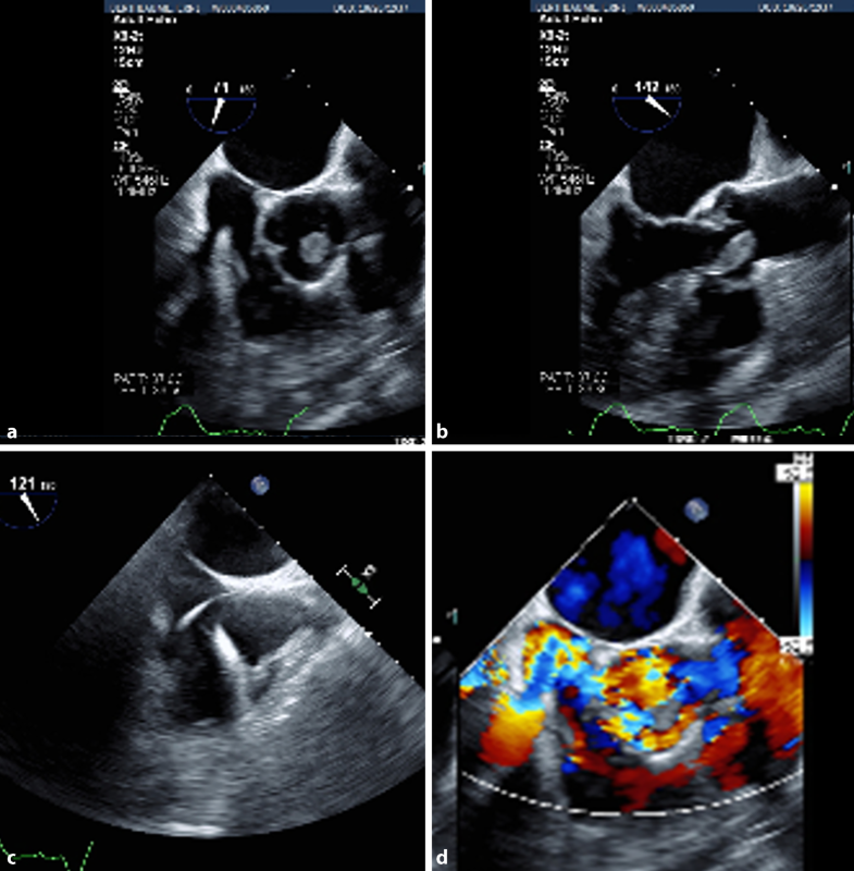 An interesting case of pacemaker endocarditis | SpringerLink