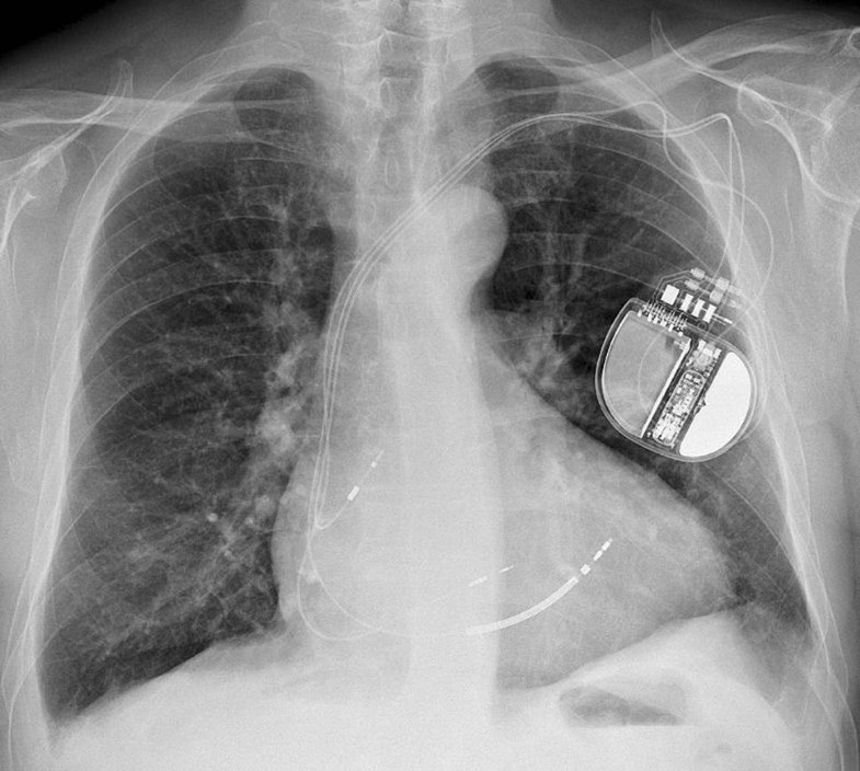 Left bundle branch area pacing for cardiac resynchronisation therapy ...