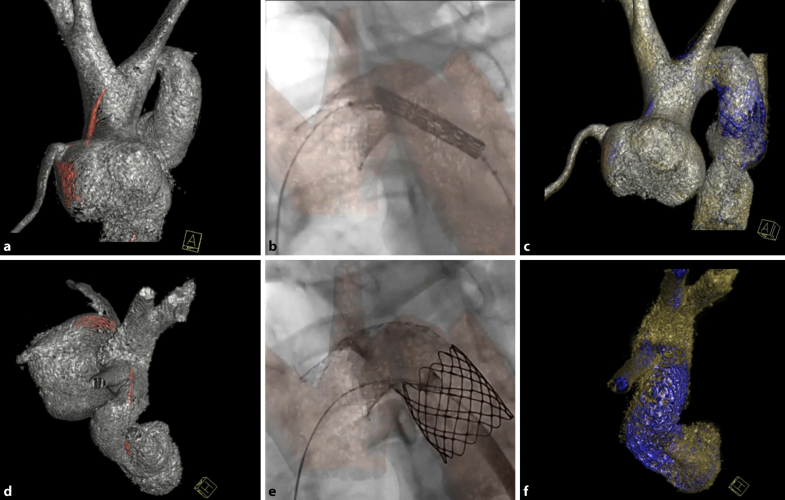 Safety and efficacy of stenting for aortic arch hypoplasia in patients ...