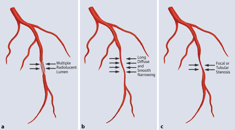 Spontaneous coronary artery dissections and associated predisposing ...