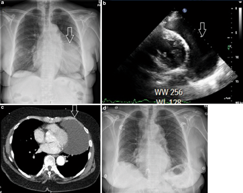 Pericardial cyst on the left heart border | SpringerLink