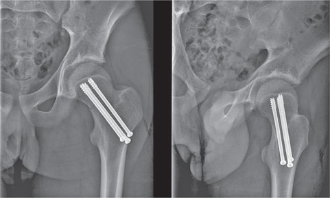 Heupfracturen bij kinderen | SpringerLink
