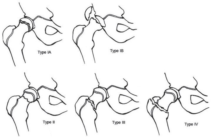 Heupfracturen bij kinderen | SpringerLink
