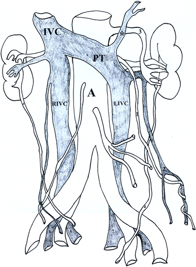 Duplication of the inferior vena cava: anatomy, embryology and ...