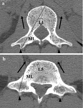 Anatomical relation between the accessory process and pedicle in the ...