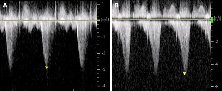 Valsalva maneuver in echocardiography | SpringerLink