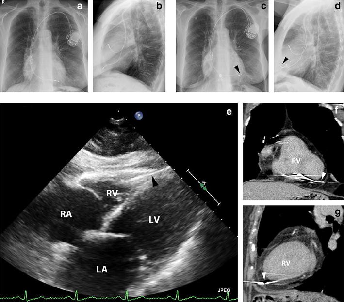 Subacute right ventricular pacemaker lead perforation: evaluation by ...