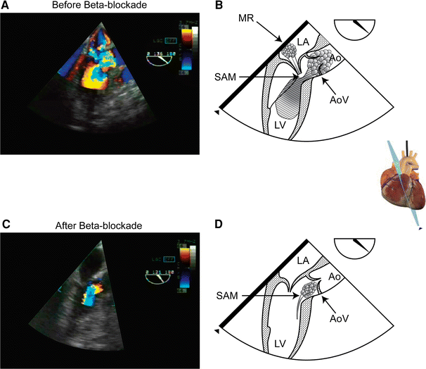 Always consider left ventricular outflow tract obstruction in ...