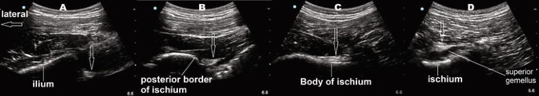 A simple and successful sonographic technique to identify the sciatic ...