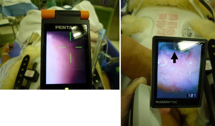 Successful tracheal intubation with the McGrath® MAC video laryngoscope ...