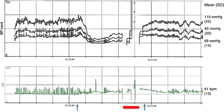 Novel use of the Nexfin HD monitor for hemodynamic management during ...