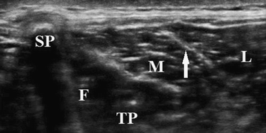 Thoracolumbar interfascial plane (TLIP) block: a pilot study in ...