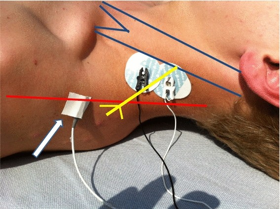 Monitoring recovery from rocuronium-induced neuromuscular block using ...