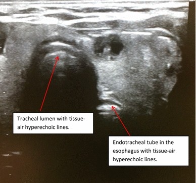 Point-of-care ultrasound (POCUS) of the upper airway | SpringerLink