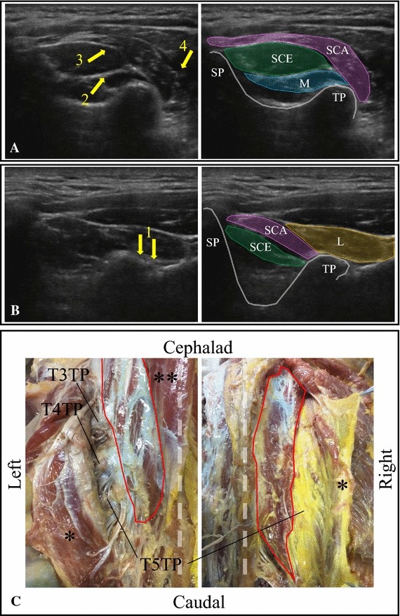 Analgesia-related differences among the erector spinae, multifidus ...