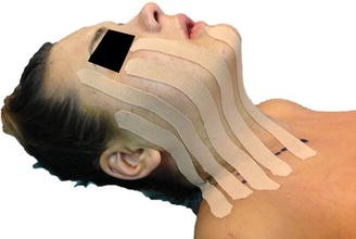 Influence of Kinesiologic Tape on Post-operative Swelling After ...