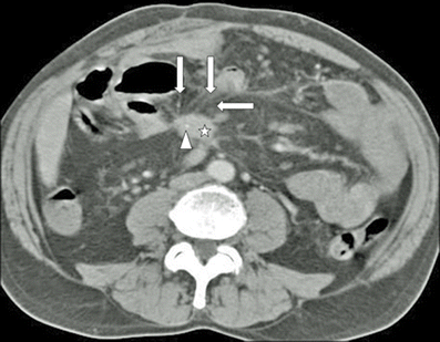 Mesenteric carcinoid | SpringerLink