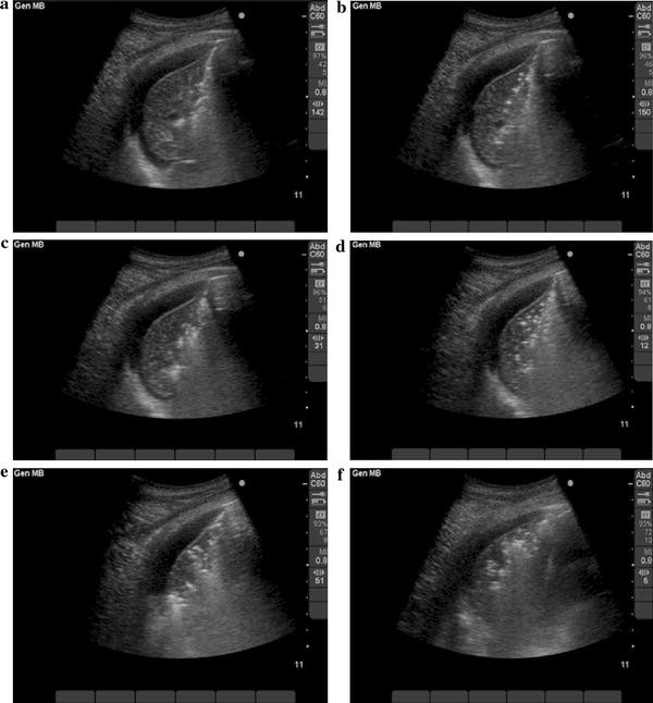 Detection of lung atelectasis/consolidation by ultrasound in multiple ...
