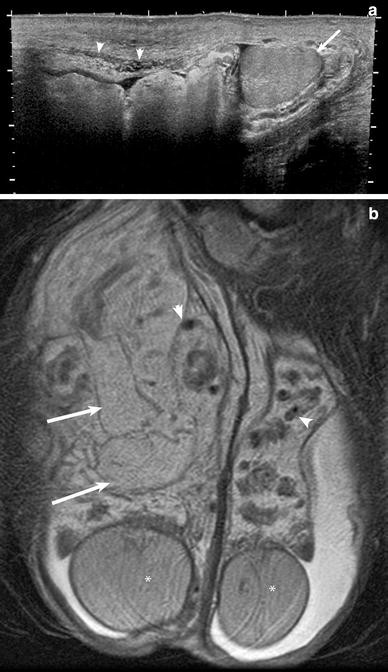 Acute scrotal ultrasound: a practical guide | SpringerLink