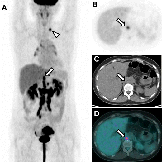 Retrocrural Lymph Node Metastasis Disclosed by 18F-FDG PET/CT: A ...