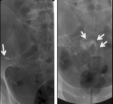 A Case of Enterocutaneous Fistula Diagnosed with Tc-99m DTPA ...