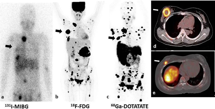 Diagnostic Performance of 68Ga-DOTATATE PET/CT, 18F-FDG PET/CT and 131I ...