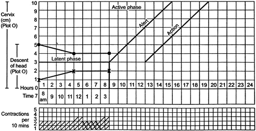 The Partograph in Childbirth: An Absolute Essentiality or a Mere ...