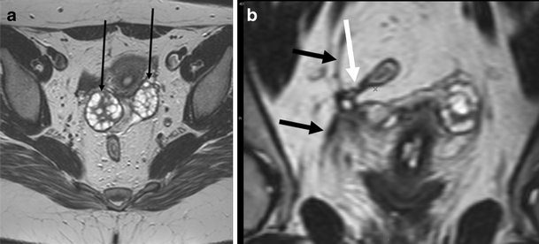 MRI for assessment of anal fistula | SpringerLink