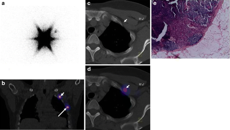 The future of hybrid imaging—part 1: hybrid imaging technologies and SPECT/CT | Insights into ...