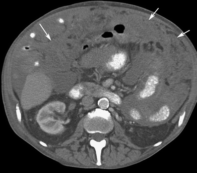 Omental cakes: unusual aetiologies and CT appearances | SpringerLink