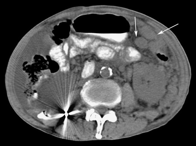 Omental cakes: unusual aetiologies and CT appearances | SpringerLink