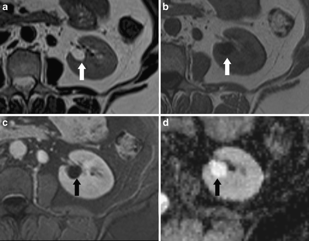 Assessment and characterisation of common renal masses with CT and MRI ...