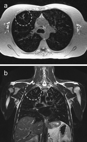 MRI of the lung (2/3). Why … when … how? | SpringerLink
