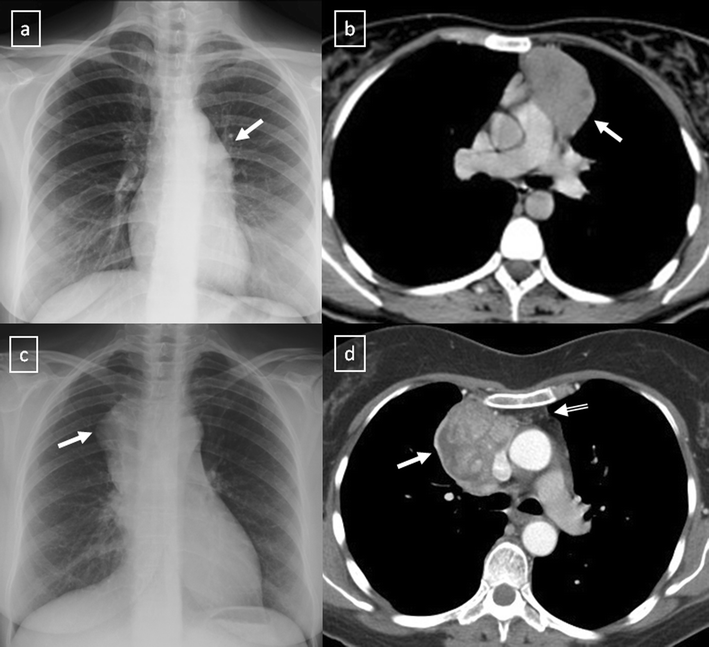 A diagnostic approach to the mediastinal masses | Insights into Imaging ...