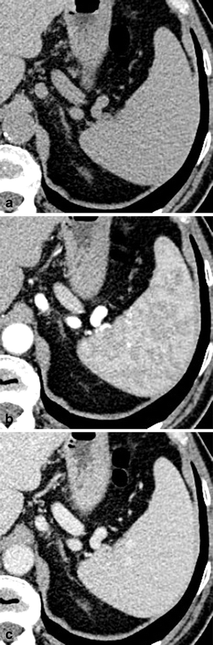 Computed tomography of the spleen: how to interpret the hypodense ...