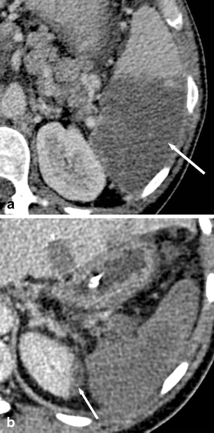 Computed tomography of the spleen: how to interpret the hypodense ...