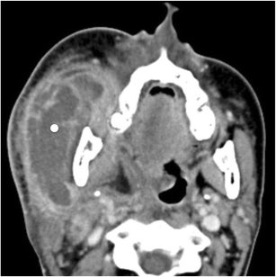 Anatomy and pathology of the masticator space | SpringerLink