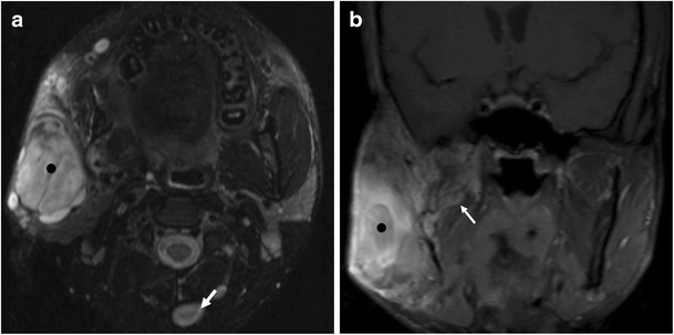 Anatomy and pathology of the masticator space | SpringerLink