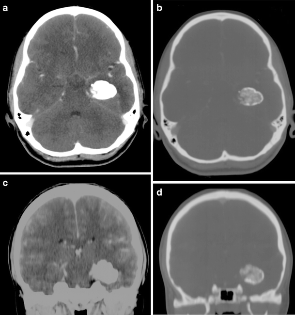 Brain stones revisited—between a rock and a hard place | SpringerLink